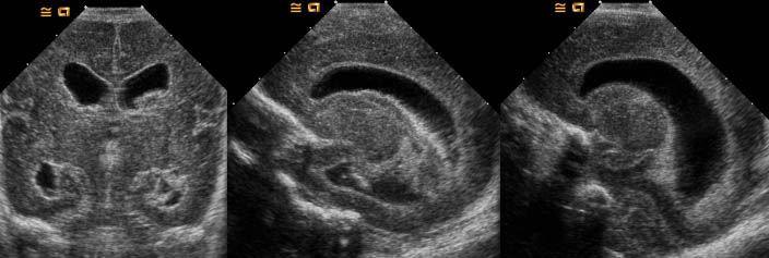 Intraventricular Hemorrhage, a pediatric clinical case review and ...