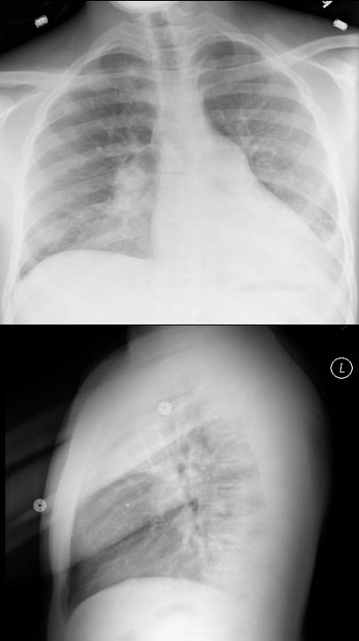Respiratory Distress and Sickle Cell Anemia, a pediatric clinical case ...