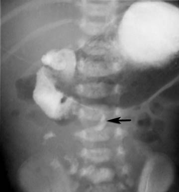 Neonatal Bilious Emesis, a pediatric clinical case review and discussion