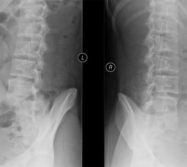 Back Pain Causes, a pediatric clinical case review and discussion