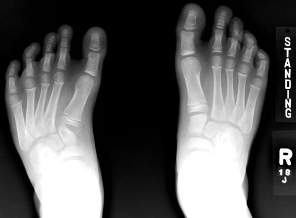 Clubfoot Epidemiology, a pediatric clinical case review and discussion