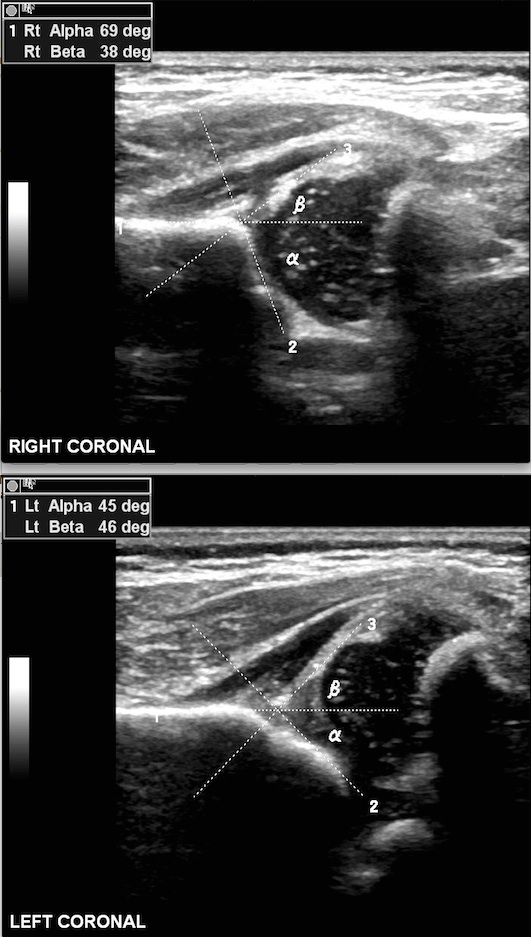 Developmental Dysplasia Of The Hip Ultrasound Developmental Dysplasia