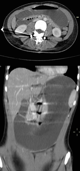 Superior Mesenteric Artery Syndrome (SMA Syndrome) , a pediatric ...