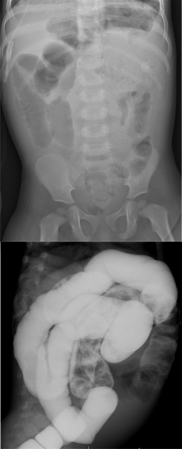 Distal Intestinal Obstruction Syndrome (DIOS), a pediatric clinical ...