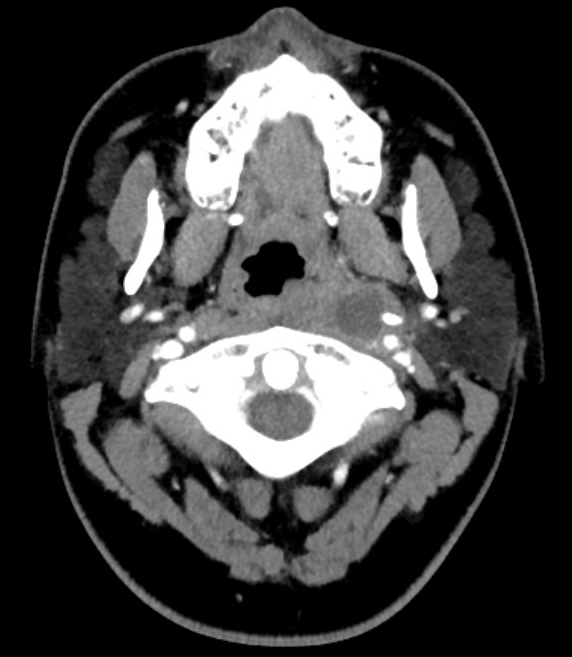 Deep Neck Infection Presentations, a pediatric clinical case review and ...