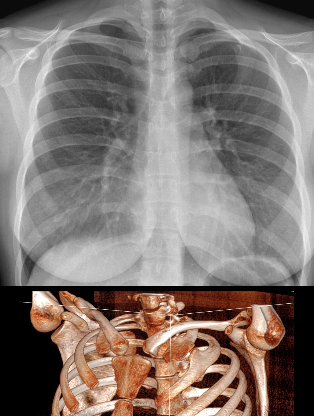 Congenital rib abnormalities, pediatric clinical case review and discussion