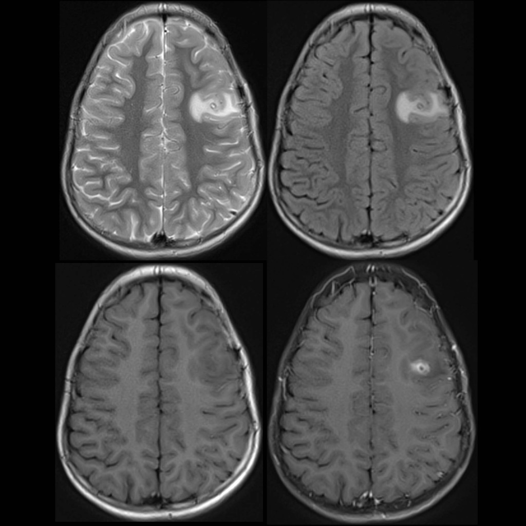 Neurocysticercosis