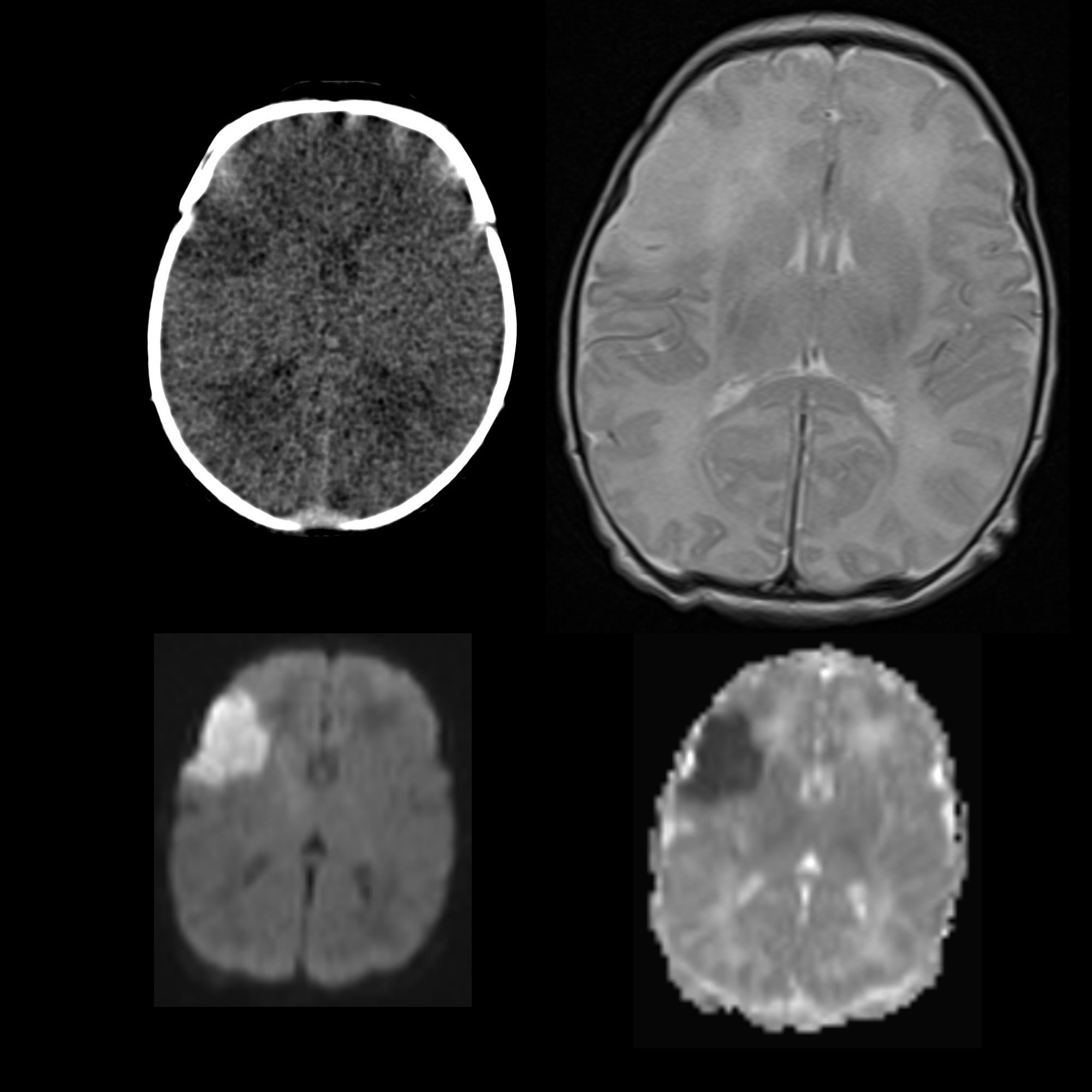 Perinatal Stroke Classification, a pediatric clinical case review and ...