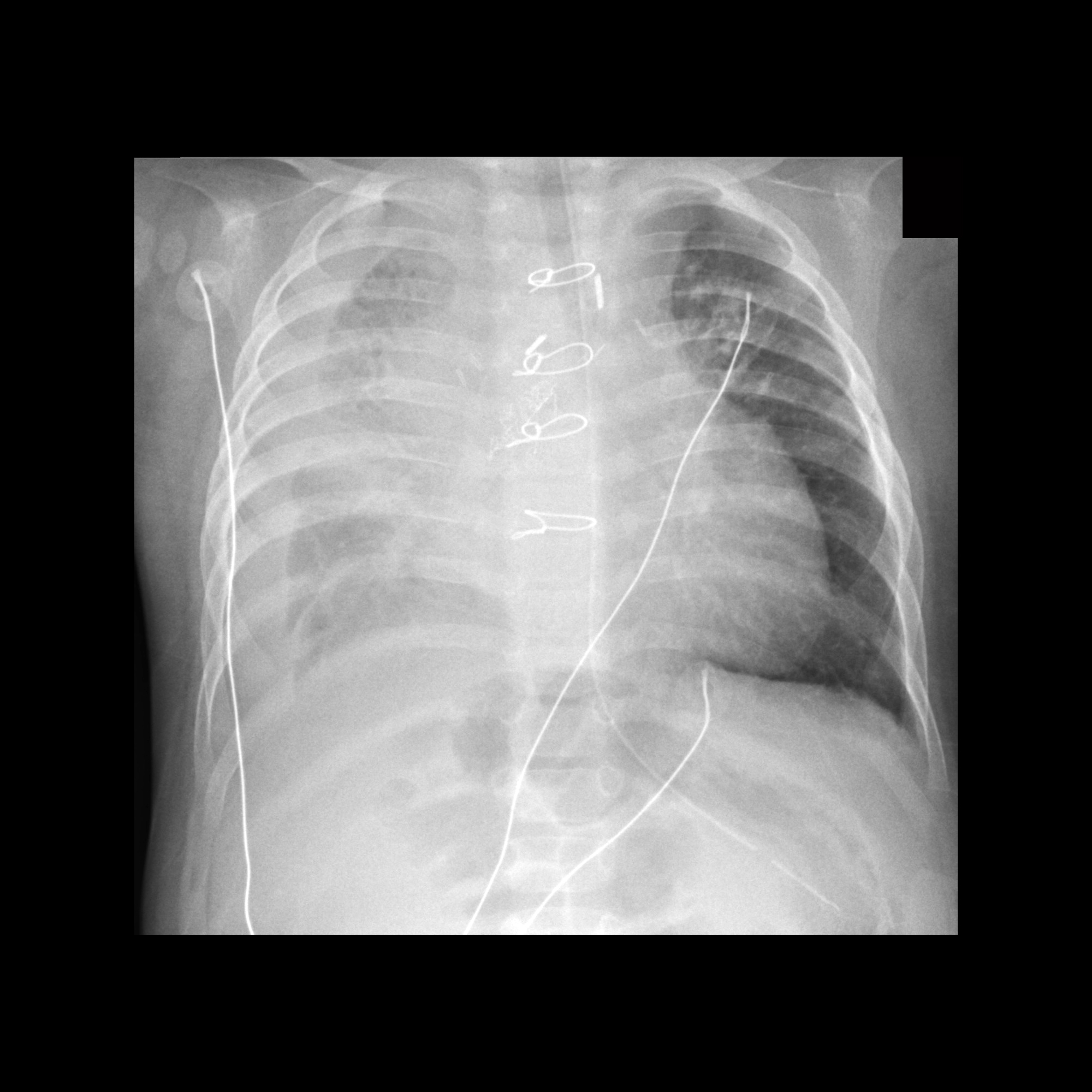 Chylothorax, a pediatric clinical case review and discussion