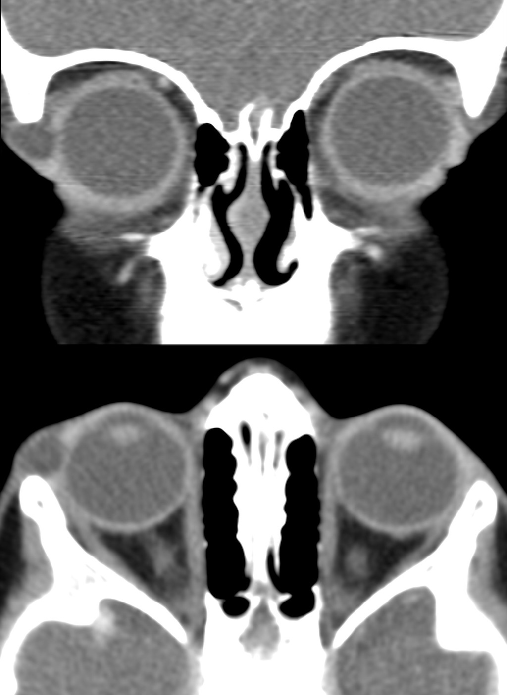 Dermoid Cysts, a pediatric clinical case review and discussion