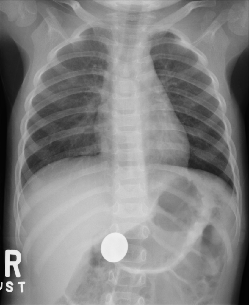 Choking, Aspiration and Ingestion, a pediatric clinical case review and ...