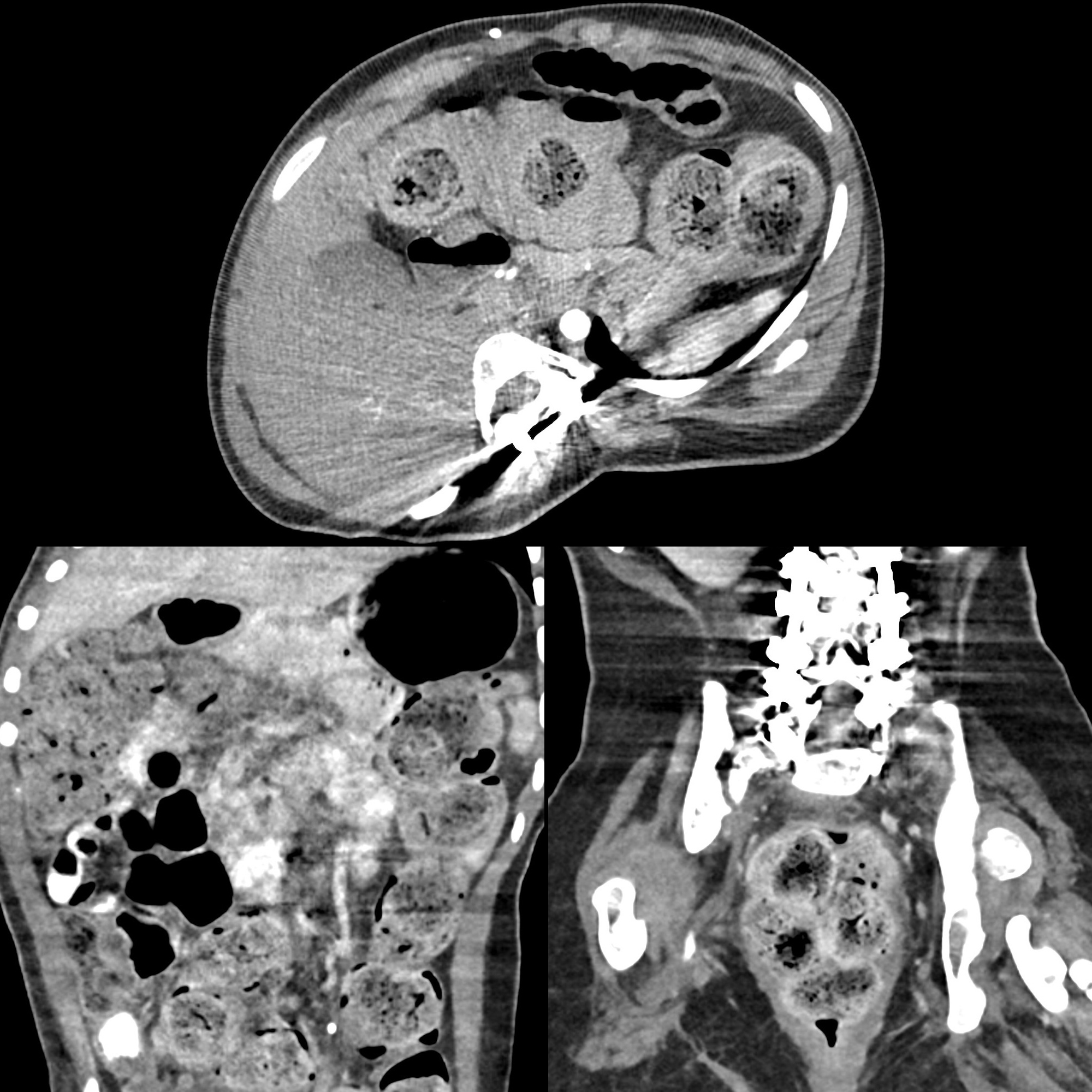 11-24-25Figure148StercoralColitis | Pediatric Case and Reference ...